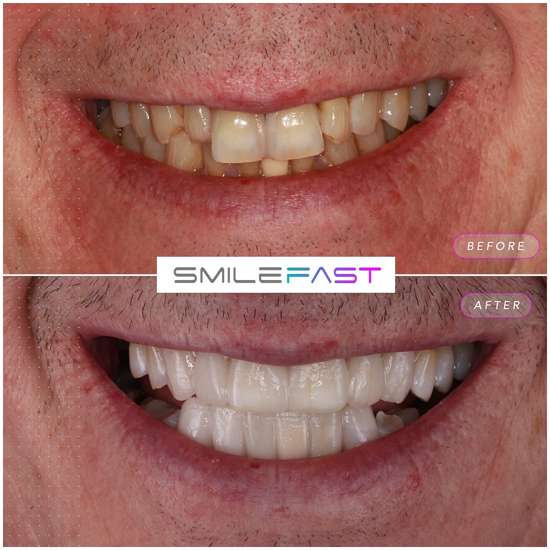 SmileFast Veneers | Toothcare Dental