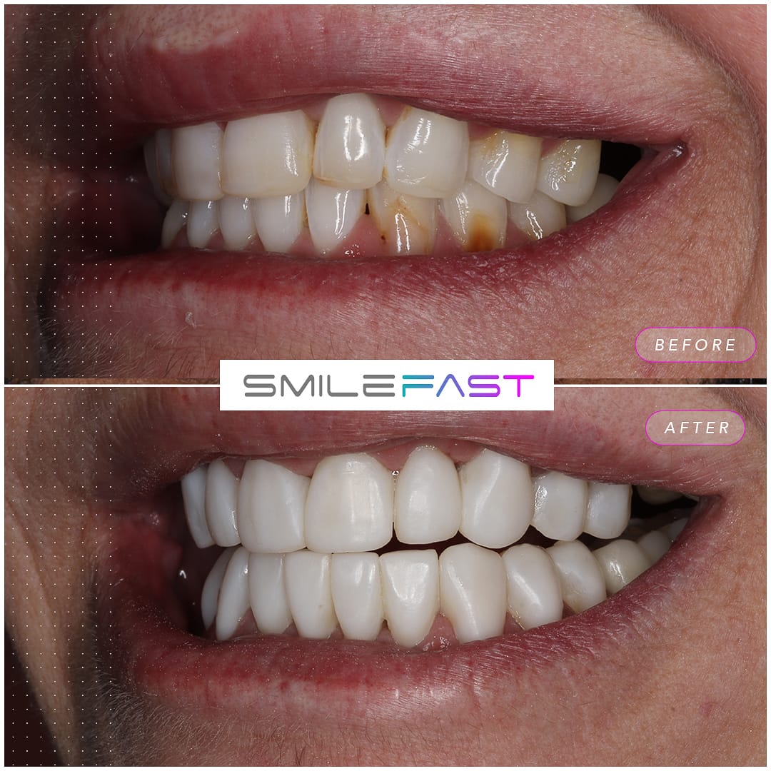 SmileFast Veneers | Toothcare Dental